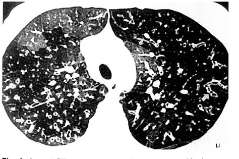 Pdf Bronchiectasis In Diffuse Panbronchiolitis High Resolution Ct
