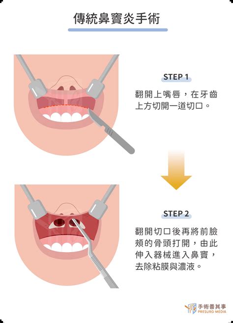 鼻竇炎會傳染嗎？會自己好嗎？症狀、原因、治療、開刀