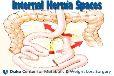 Internal Hernia Bariatric Surgery Education