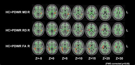 The Result Of The Tbss Analysis In The Whole Brain For The Sake Of Download Scientific Diagram
