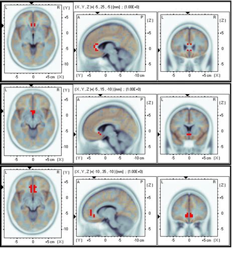 Table 1 From Alpha Power Alpha Asymmetry And Anterior Cingulate