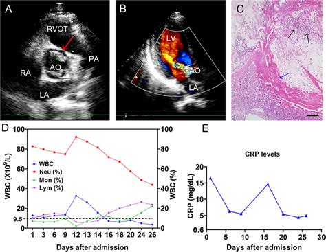 Endocarditis Case Report Abstract At Gail Key Blog