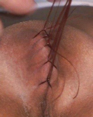 Sewn Up Pussy Porn Pictures XXX Photos Sex Images PICTOA