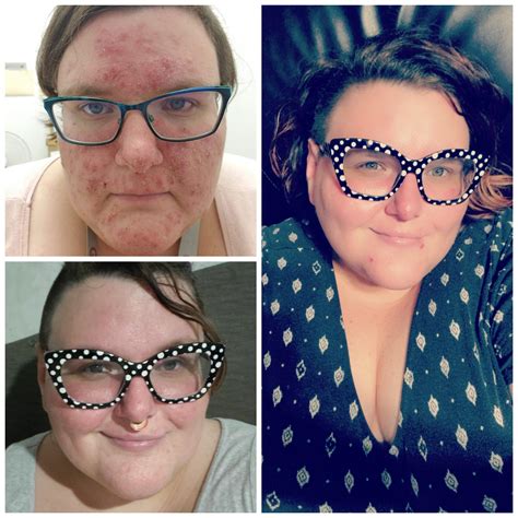 35 Cystic Acne Rosacea Pcos 3 Years Later R30plusskincare
