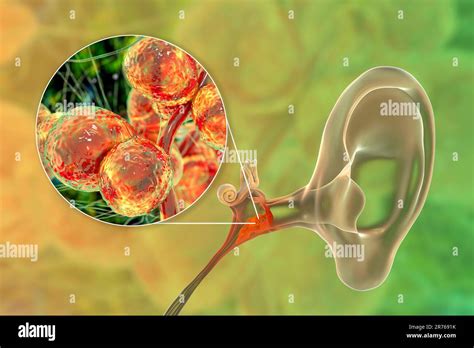Chronic Fungal Otitis Media Ear Infection Computer Illustration Showing Inflammation Of The