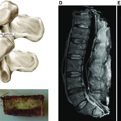 A Schematic Drawing Representative Of Functional Spine Unit And