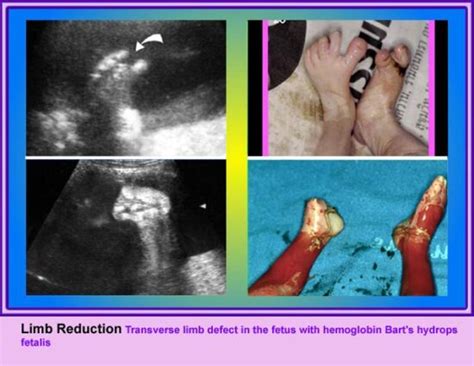 Limb Reduction Defects Department Of Obstetrics And Gynecology Faculty Of Medicine Chiang Mai