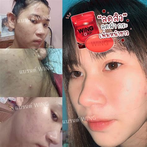 กรี้ดดด หน่อย ได้ไหม ในความน่ารัก ที่ ลค ทักมา ส่ง รีวิว สบู่วิ้ง ให้ 📍แพ้ครีม แพ้ทุกสิ่ง แพ้