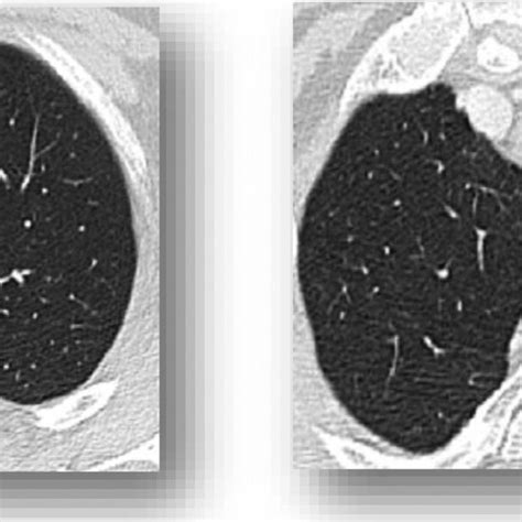 Chest Ct Scan Axial Slices Through The Parenchymal Window Passing Download Scientific Diagram