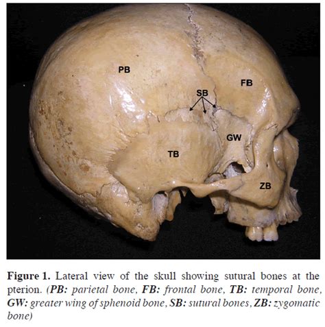 Sutural Bone