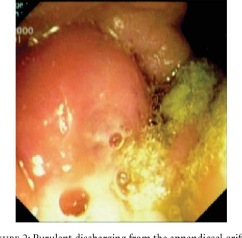 Figure 1 From Incidental Diagnostic And Treatment Of A Suppurative