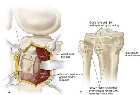 Limb Length Discrepancy Musculoskeletal Key