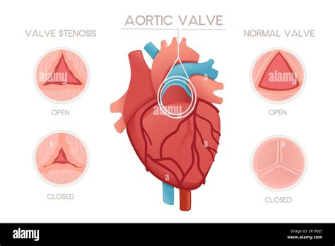 Healthy Human Heart With Valves And Valve Stenosis Disease Anatomy