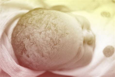 Caput Succedaneum Causes Symptoms And Treatment