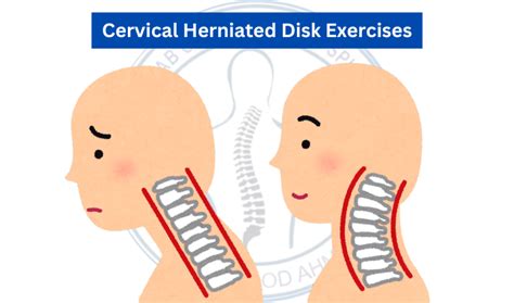 Best Cervical Herniated Disk Exercises And Stretches Dr Mahmood Ahmad