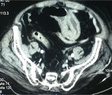 Ct Scan Showing A Luminal Narrowing And A Thickening Of The Ileum Wall