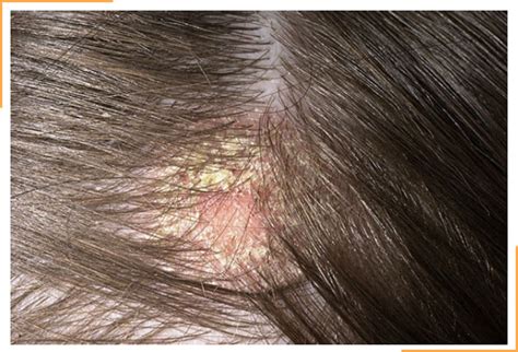 Psoriasis Scalp