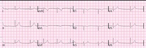 Dr Smith S ECG Blog When The Conventional Algorithm Diagnoses The ECG