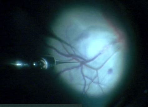 Ocriplasmin Was Injected Into The Subretinal Space Leading To A