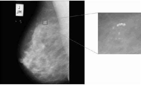 An Example Of Micro Calcification In Mammogram Image Download Scientific Diagram