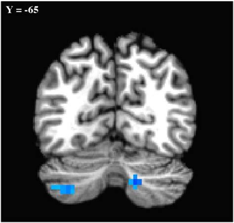 Sex Differences In Resting State Functional Connectivity Of The