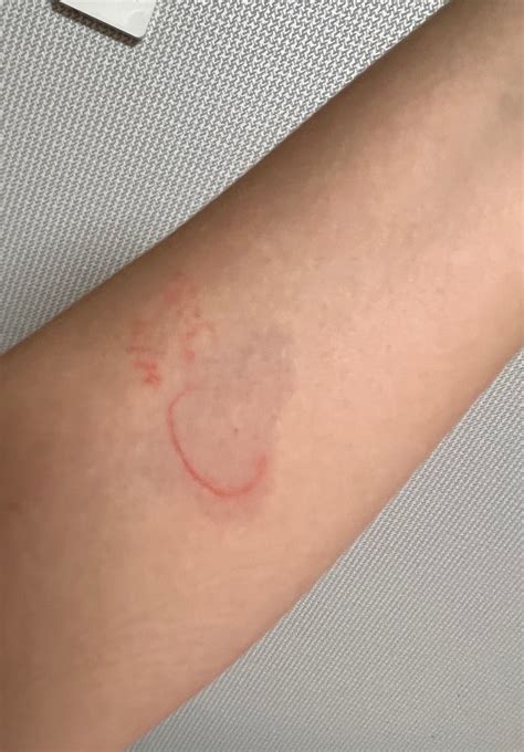 항생제 반응 검사 후 붉게 착색되었어요 지식in