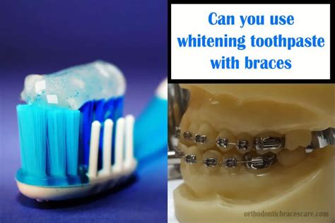 Can You Use Whitening Toothpaste With Braces Invisalign Retainers Orthodontic Braces Care