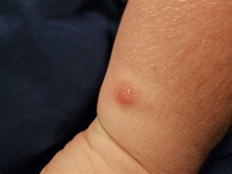 Spider Bite R Spiderbites