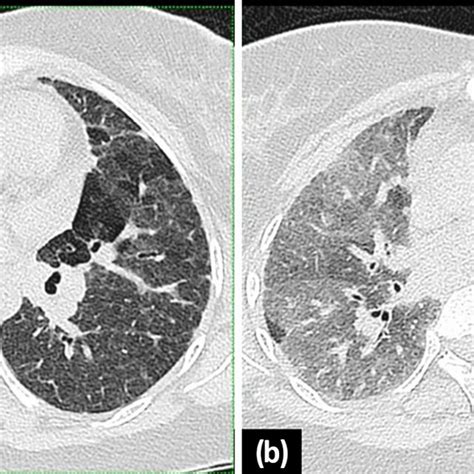 Non Fibrotic Hypersensitivity Pneumonitis Axial Hrct Image Below The Download Scientific