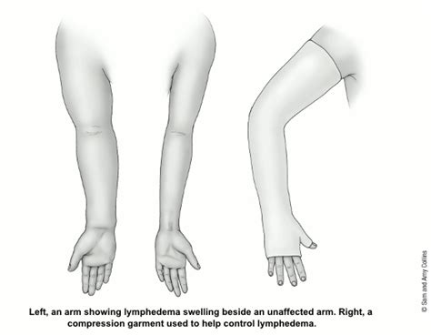 Lymphedema American Cancer Society