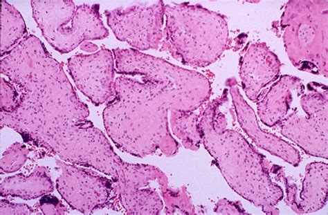 Chorionic Villi Histology