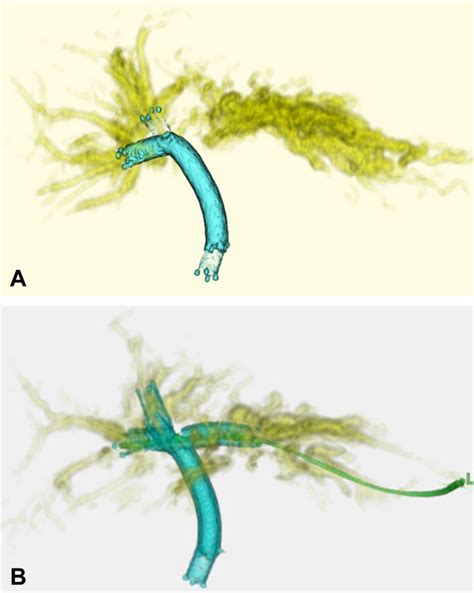 A Novel Method Of Bilateral Biliary Decompression By Eus Guided Hepaticogastrostomy With