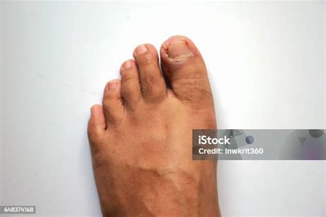 손톱 사고 손톱 외상 발가락 손톱 출혈 발 궤 양 손톱 손 발톱을 알아낼 발톱에 대한 스톡 사진 및 기타 이미지 발톱 건강관리와 의술 곰팡이 Istock