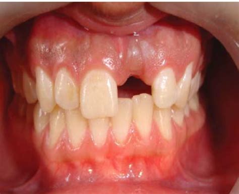 Intraoral Photograph Showing Missing Left Central Incisor Download
