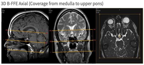 Trigeminal Nerve Mri