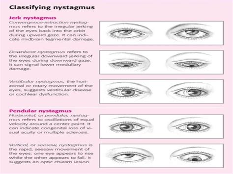 Nystagmus By Yehia Matter
