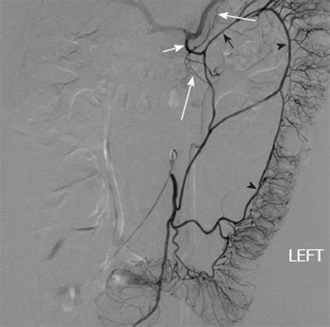 Superior Mesenteric Artery Angiogram