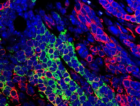 Tailoring Treatment For Triple Negative Breast Cancer