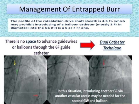 Complication And Management Of Rotablation Ppt