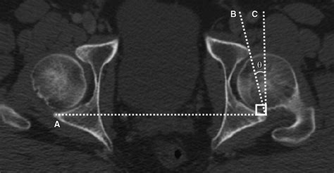 Cam Type Morphology Radiology At Charles Grose Blog