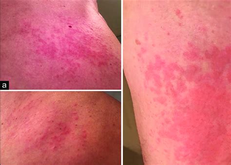 External Photographs A The Skin Over The Abdomen Reveals A Download Scientific Diagram