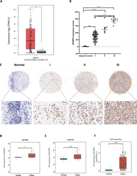 Igf2bp3 Enhances Lipid Metabolism In Cervical Cancer By Upregulating The Expression Of Scd Pmc