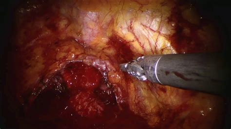 Surgical Tool Instance Seg Instance Segmentation Dataset And Pre Trained Model By Shayancustom