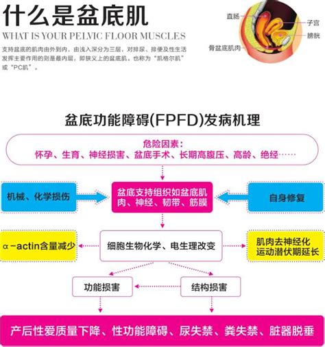 防治女性盆底功能障碍刻不容缓