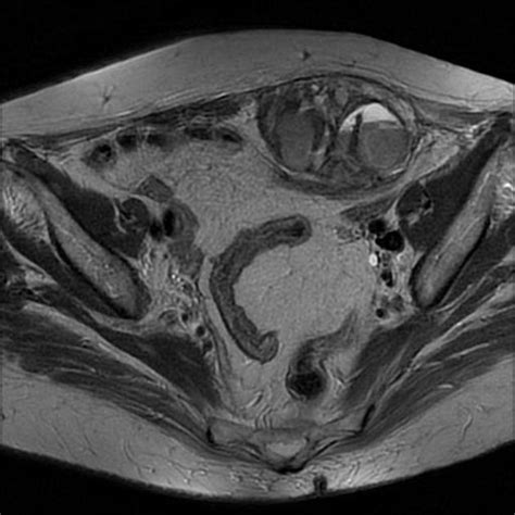 Rectus Sheath Haematomata Pacs