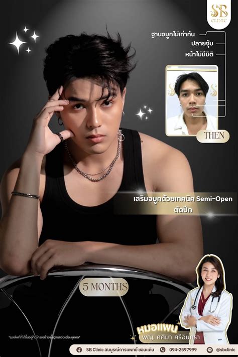 รูป Sb Clinic สมบูรณ์การแพทย์ ขอนแก่น เสริมจมูกขอนแก่น สมบูรณ์การแพทย์