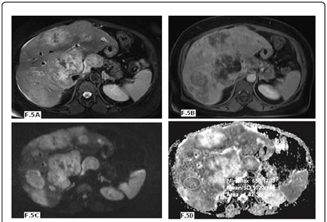 Sixty One Year Old Man With Multiple Hepatic Metastasis A Axial T2w Download Scientific