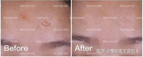 凹陷疤痕用什么方法可以恢复得更好？ 知乎