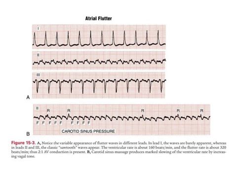 Atrial Fib And Atrial Flutter Pptx