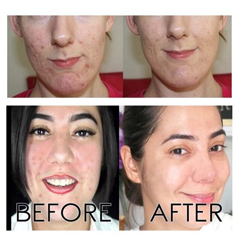 The Ordinary Peeling Solution Before And After A Comprehensive Review